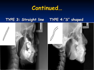 classification of soft palate and residual ridge | PPT
