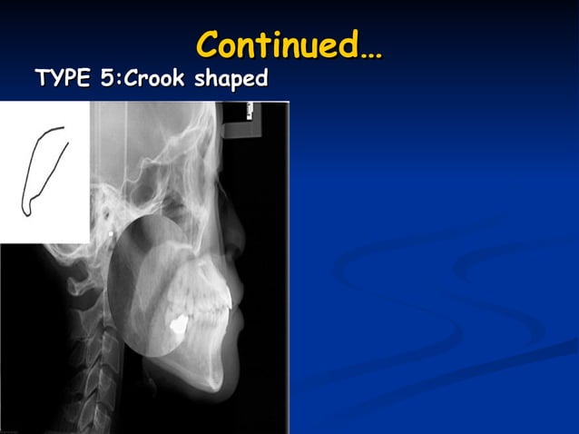 classification of soft palate and residual ridge | PPT