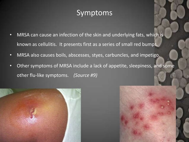 MRSA - Mobius Human Disease Project | PPT