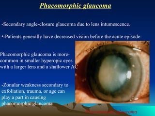 acute intra-ocular pressure rise | PPT