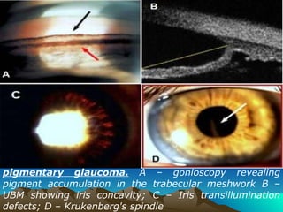 acute intra-ocular pressure rise | PPT