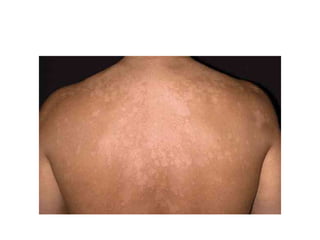 Skin Diseases On Back