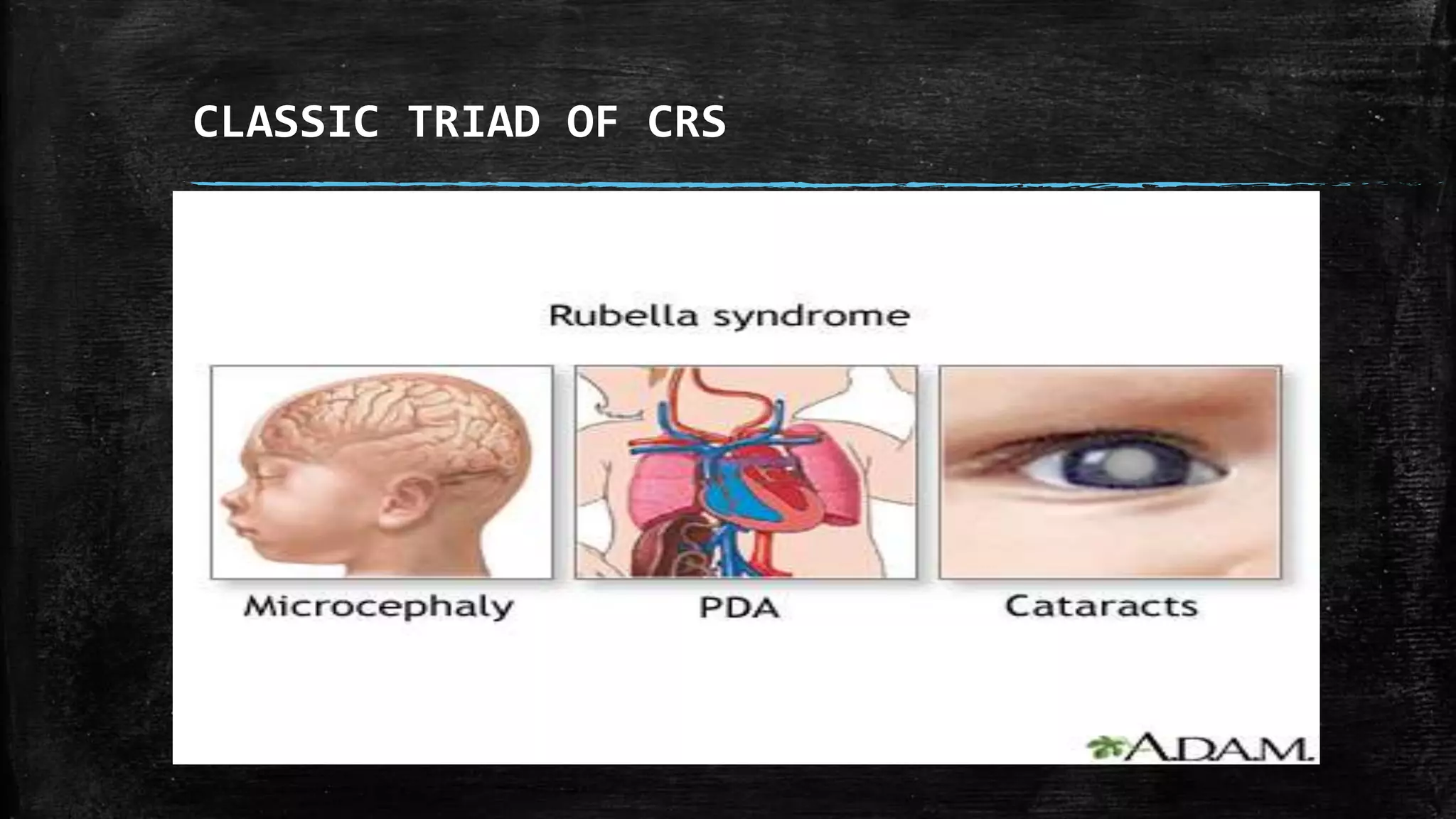 CONGENITAL RUBELLA SYNDROME | PPTX