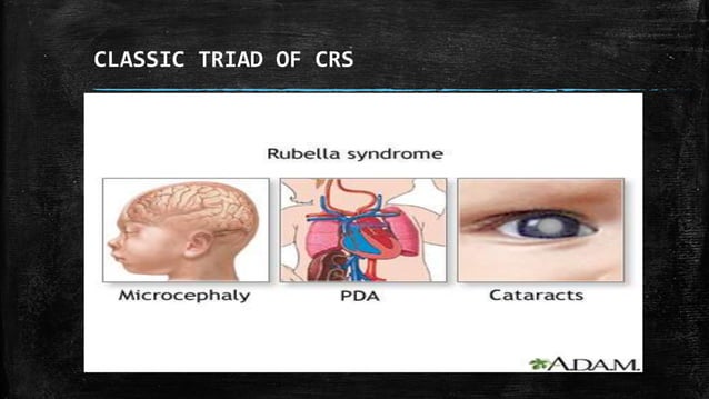 CONGENITAL RUBELLA SYNDROME | PPTX | Pregnancy | Reproductive Health