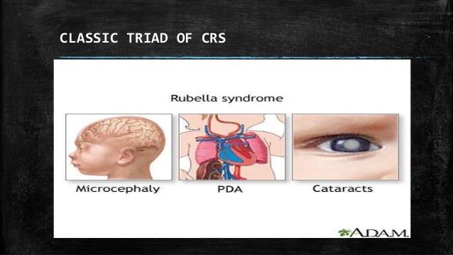 CONGENITAL RUBELLA SYNDROME