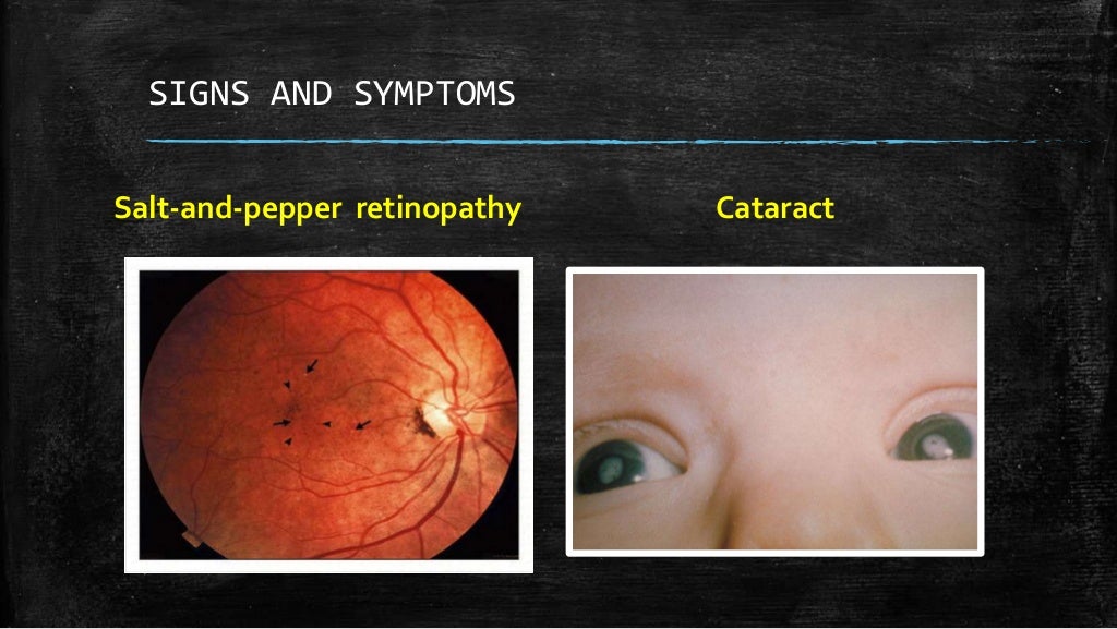 CONGENITAL RUBELLA SYNDROME