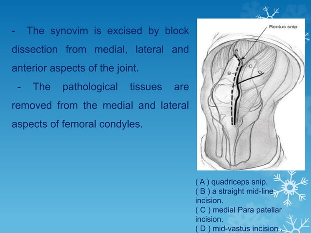 arthroscopic versus open synovectomy in rheumatoid knee | PPTX | Bone ...