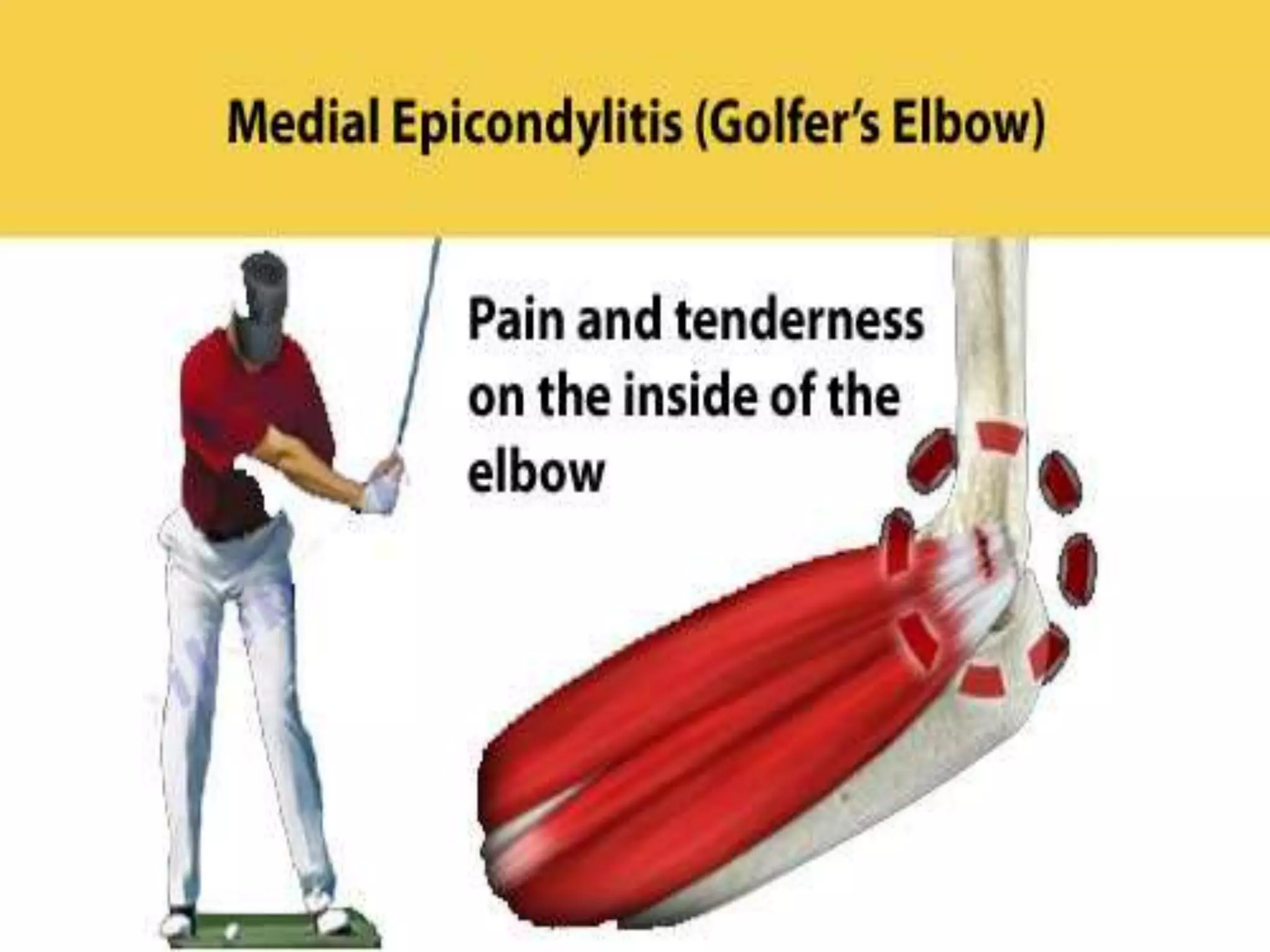 lateral & medial epicondylitis | PPTX