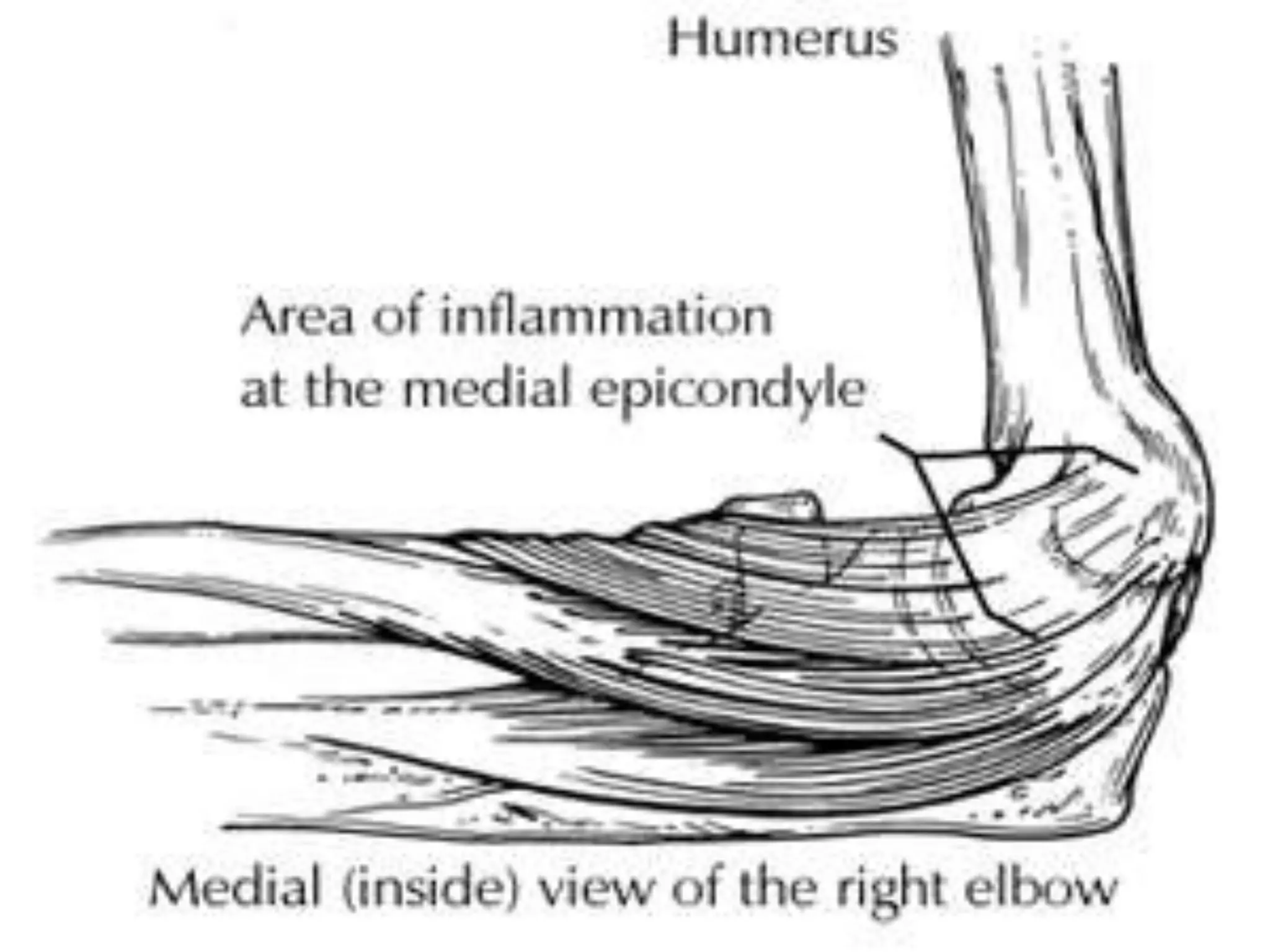 lateral & medial epicondylitis | PPTX