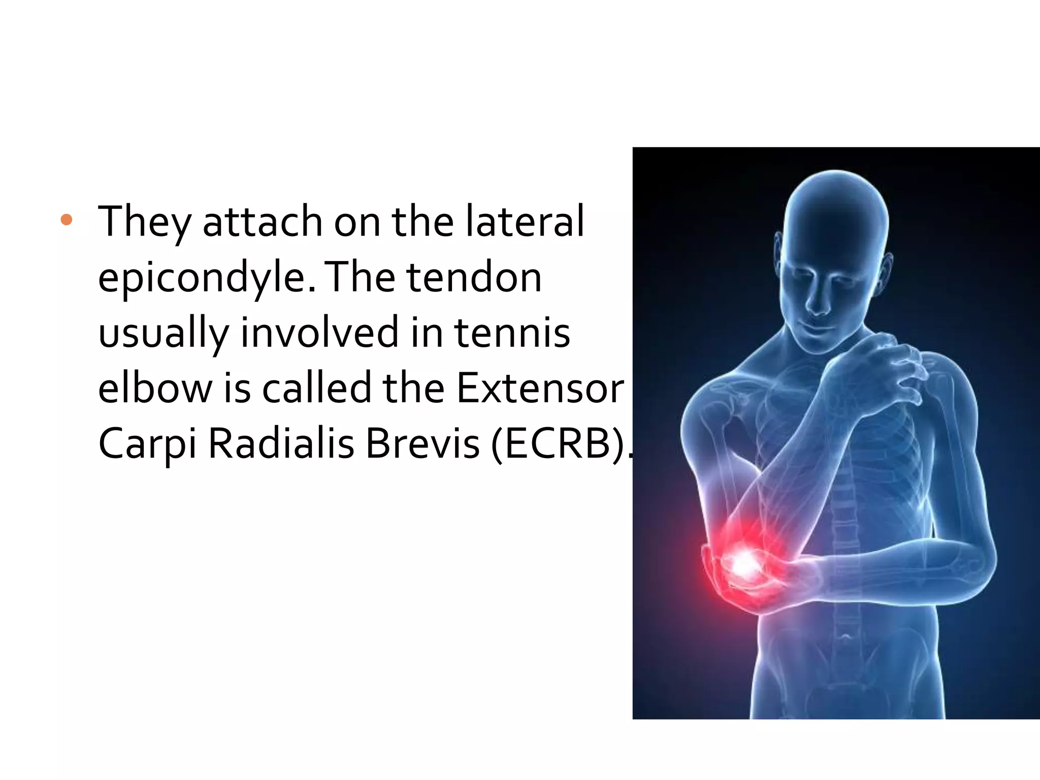 lateral & medial epicondylitis | PPTX