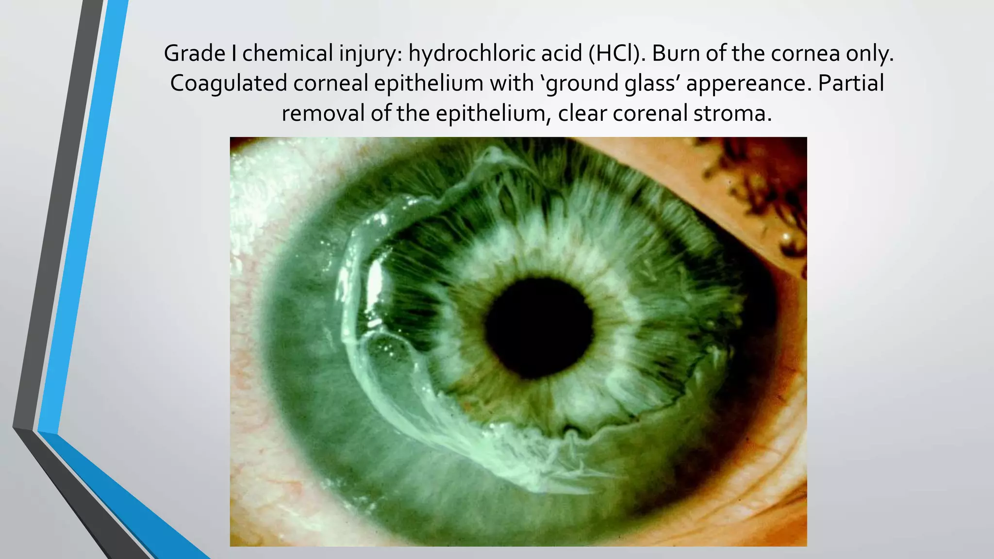 chemical eye injuries, approach and management | PPTX