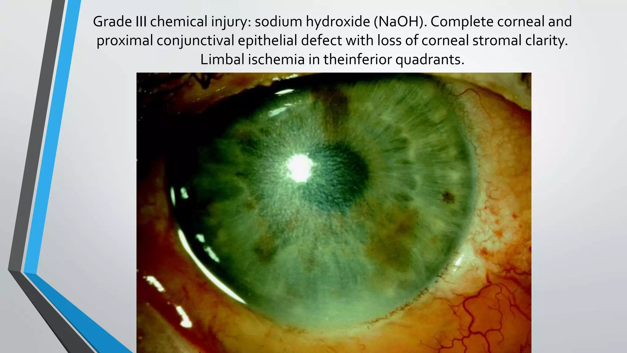 chemical eye injuries, approach and management | PPTX