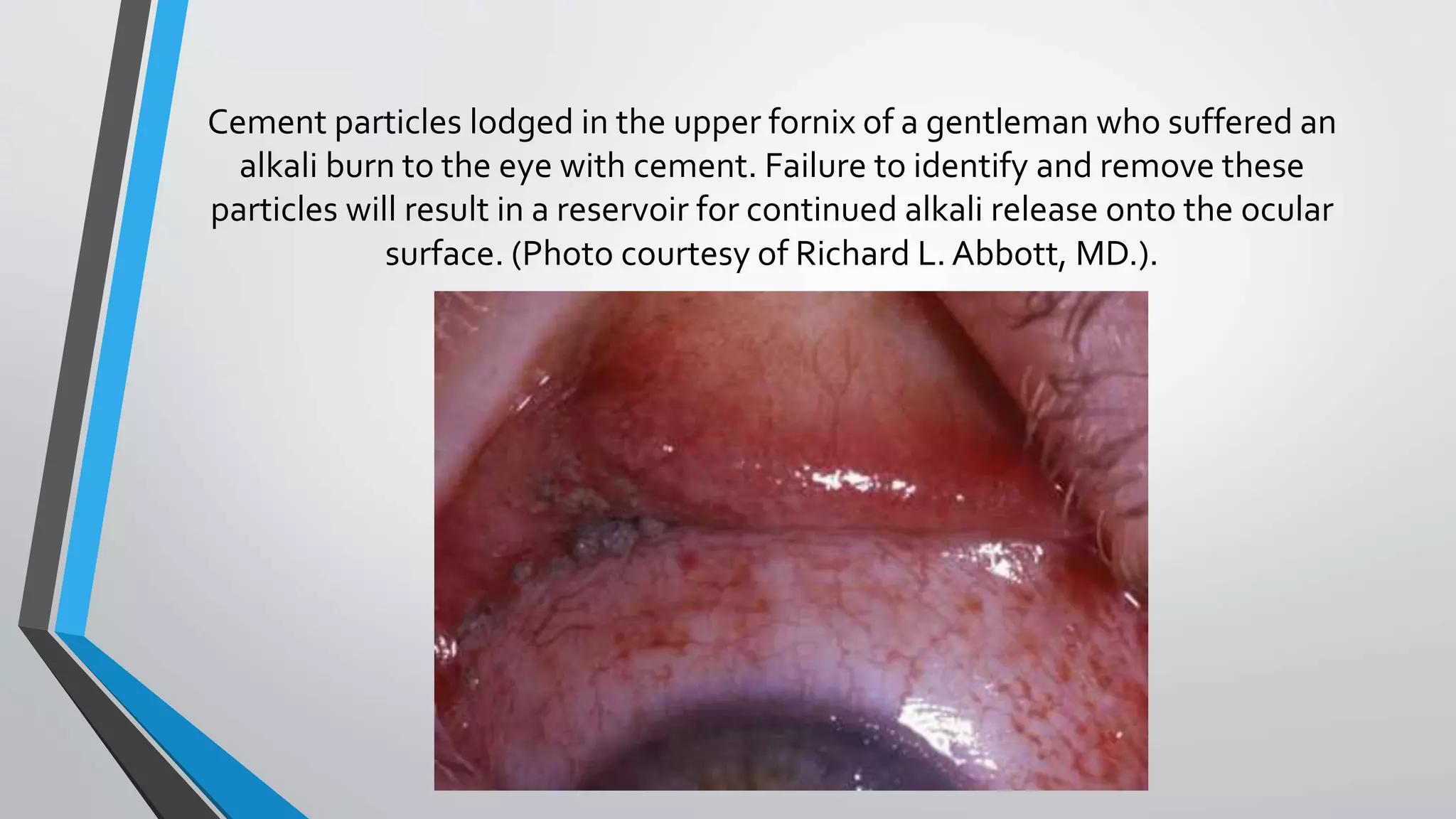 chemical eye injuries, approach and management | PPTX