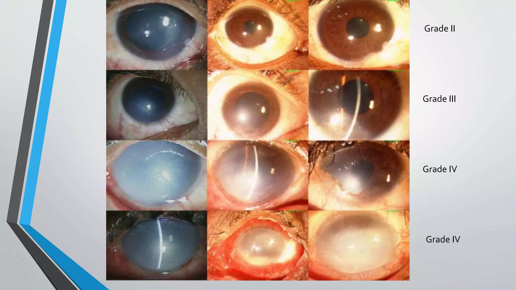 chemical eye injuries, approach and management | PPTX