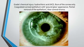 chemical eye injuries, approach and management | PPTX