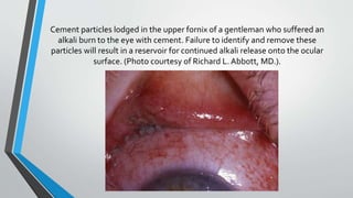 chemical eye injuries, approach and management | PPTX