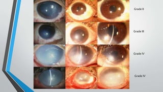 chemical eye injuries, approach and management | PPTX