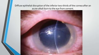 chemical eye injuries, approach and management | PPTX