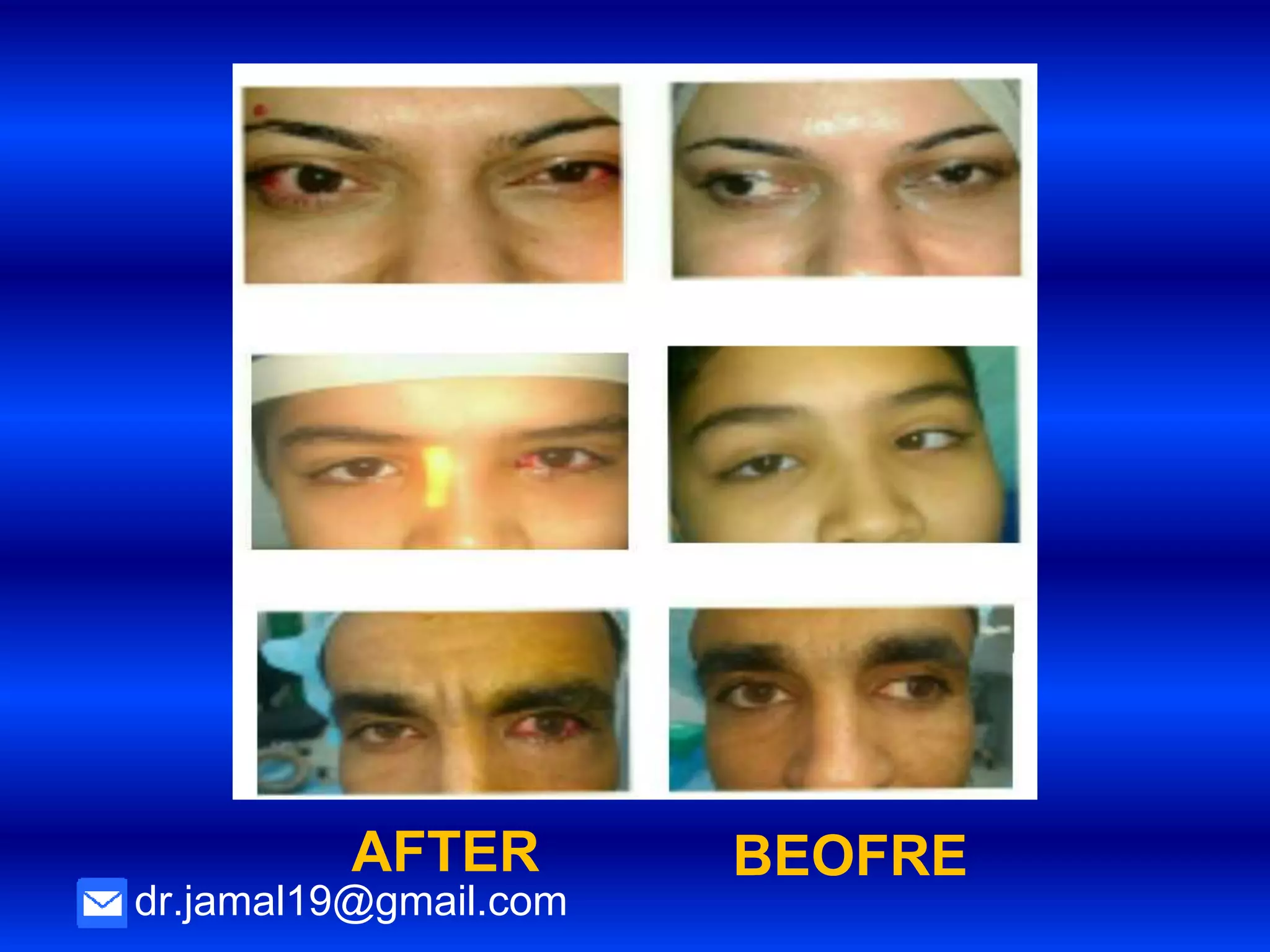 Myectomy non-suture technique for large angle strabismus surgery | PPT