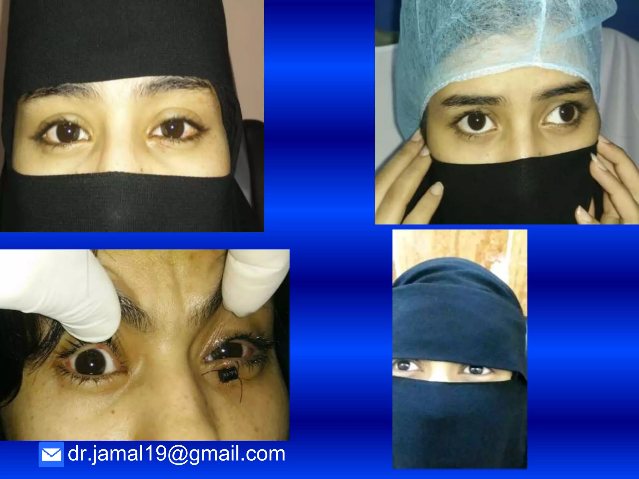 Myectomy non-suture technique for large angle strabismus surgery | PPT