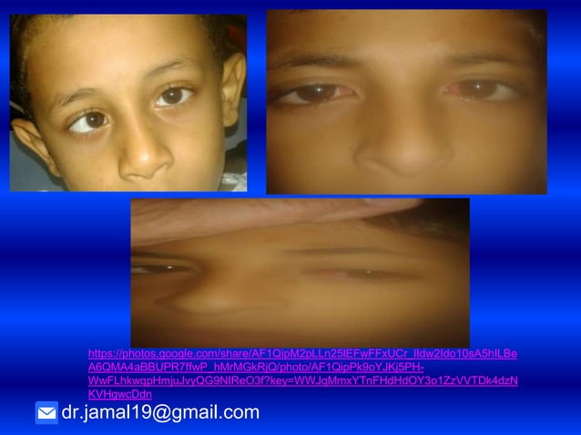 Myectomy non-suture technique for large angle strabismus surgery | PPT