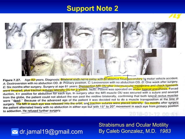 Myectomy non-suture technique for large angle strabismus surgery | PPT