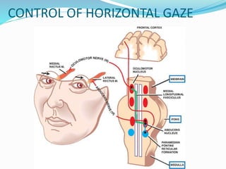 one and half syndrome | PPTX