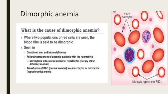 anemia, cobalamin deficiency , megaloblastic anemia, dimorphic anemia…