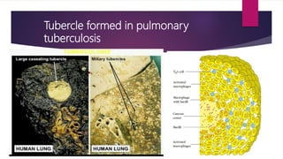 Immune Resopnse to Tuberculosis | PPTX