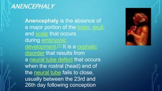 Congenital Abnormalities neuro | PPTX