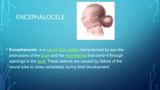 Congenital Abnormalities neuro | PPTX
