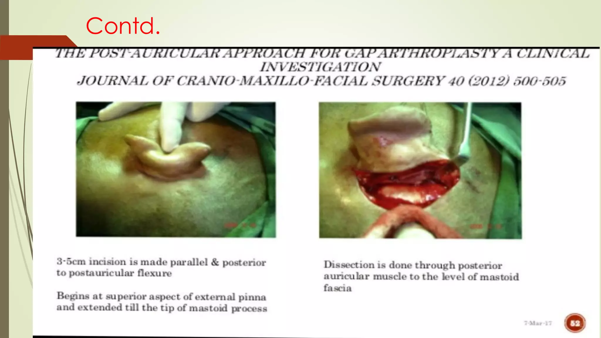Extraoral Surgical Approaches to Temporomandibular Joint | PDF