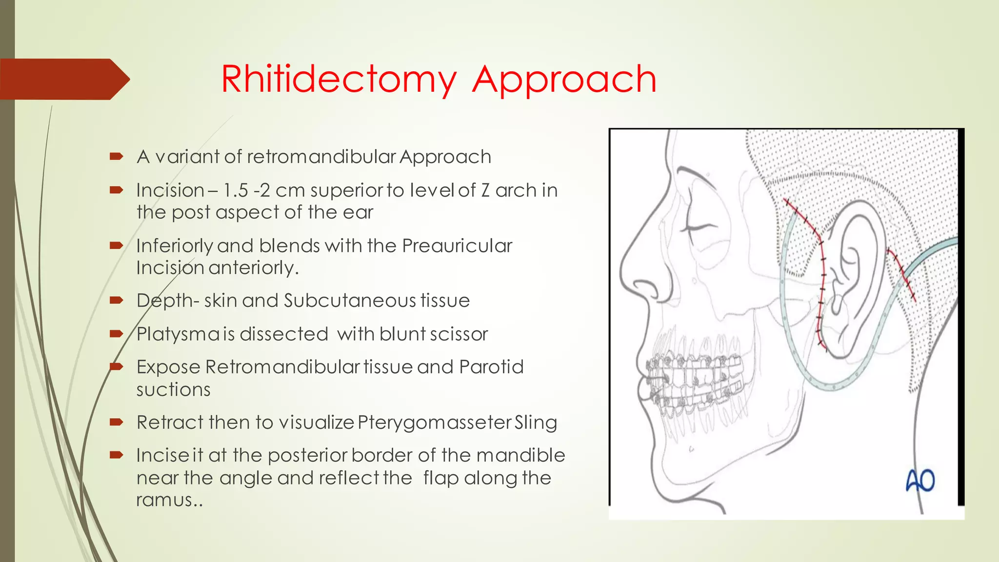 Extraoral Surgical Approaches to Temporomandibular Joint | PDF