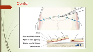 Extraoral Surgical Approaches to Temporomandibular Joint | PDF