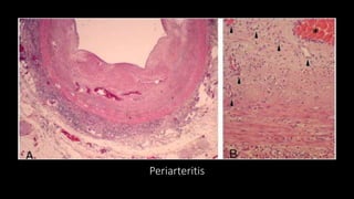 Spontenous Coronary Artery dissection (SCAD) | PPT