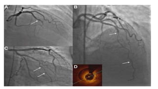 Spontenous Coronary Artery dissection (SCAD) | PPT