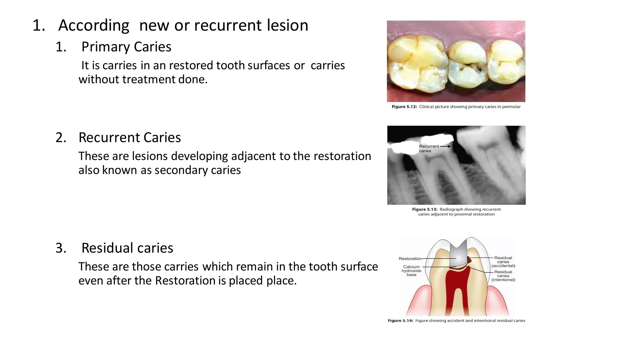 Dental caries | PDF
