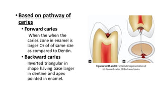 Dental caries | PPT