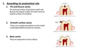 Dental caries | PPT