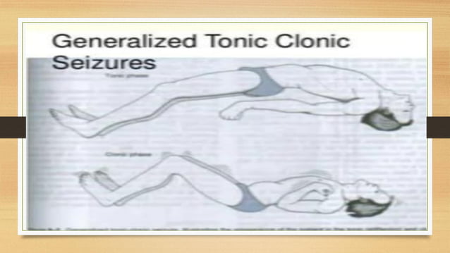SEIZURE DISORDER | PDF