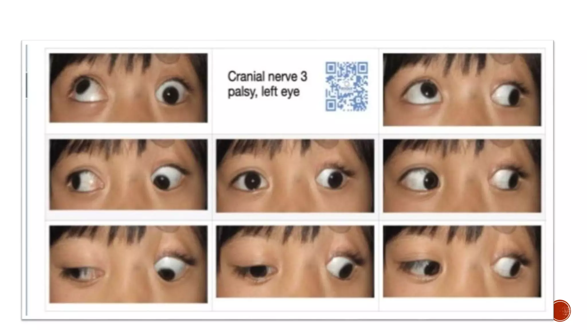 Diplopia charting.pdf