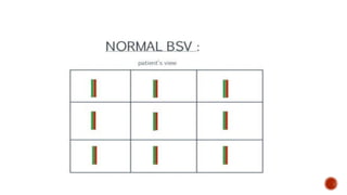 Diplopia charting.pdf