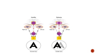 Diplopia charting.pdf