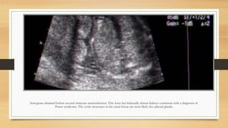 Potter syndrome | PPTX