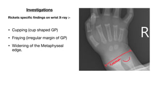 Rickets disease | PDF
