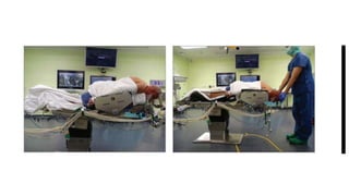 Chiari I Decompression | PPT