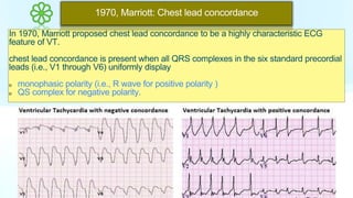 How to differentiate VT from SVT | PPTX
