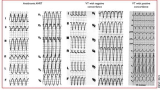 How to differentiate VT from SVT | PPTX
