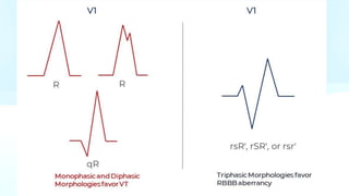 How to differentiate VT from SVT | PPTX