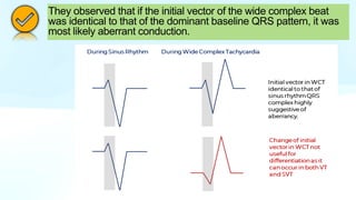 How to differentiate VT from SVT | PPTX